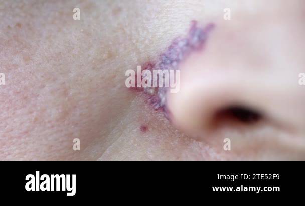 Spider veins nose Stock Videos & Footage - HD and 4K Video Clips - Alamy