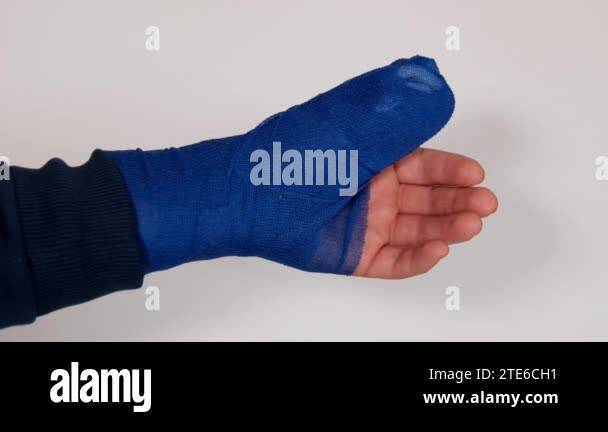 Bandaged hand.Surgical dressing. Broken arm. Blue surgical bandage on ...