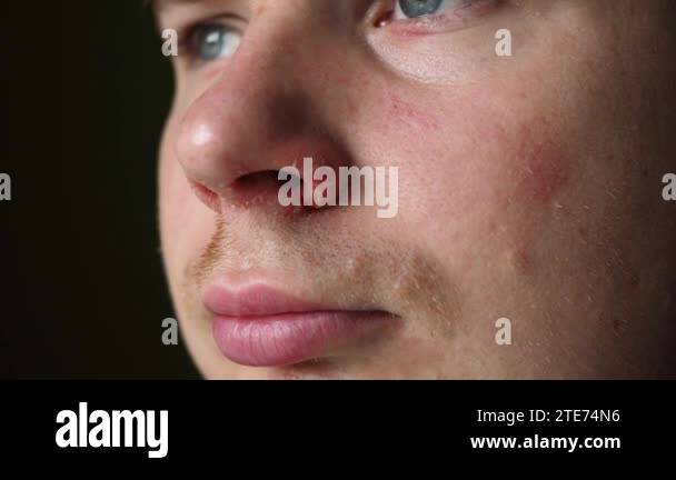 a sore nose after a runny nose close-up. cracked skin on the nose. sore ...