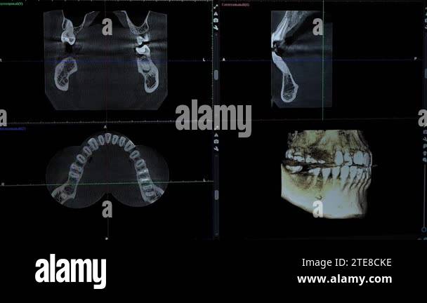 3d model of an x-ray image of a human jaw. Computer program for dental ...