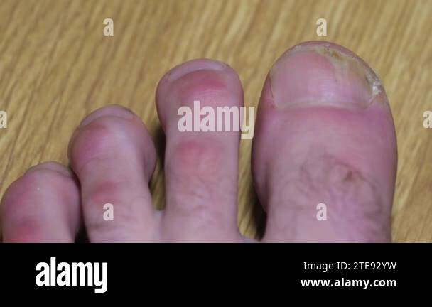 Onycholysis: detachment of the nail from the nail bed. Fungal nail ...
