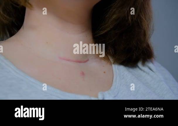 Scar on the neck. surgical wounds, removal of tumor and thyroid cancer ...
