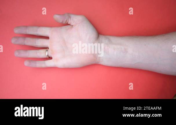 a scar on the wrist from tendon and nerve surgery, a cut on the hand ...