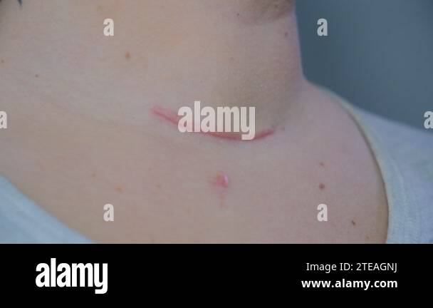 Scar on the neck. surgical wounds, removal of tumor and thyroid cancer ...