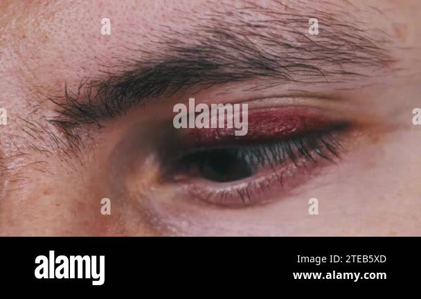 Bruise over the eye of a man, close-up. Young male face with a black ...
