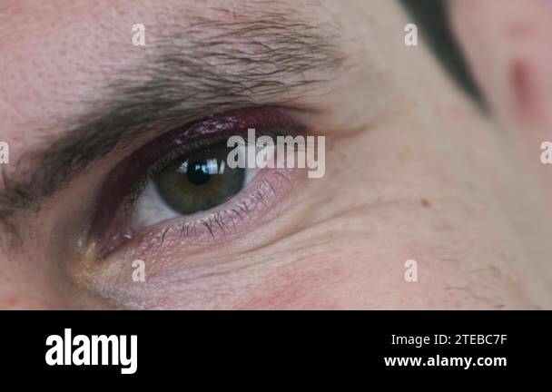 Bruise over the eye of a man, close-up. Young male face with a black ...