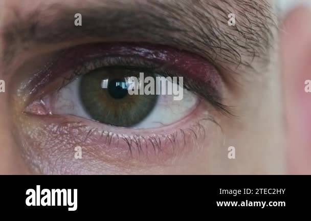 A real black eye on the young male face. A bruise on a mans eyelid ...