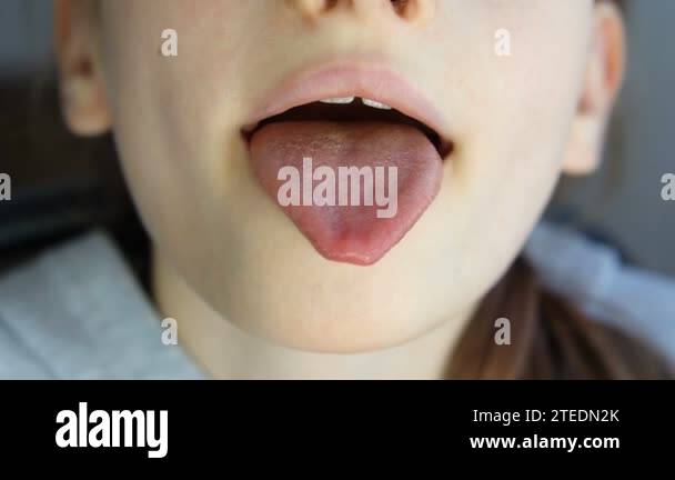 Wide Open Mouth Revealing Teeth Tongue Palate And Uvula