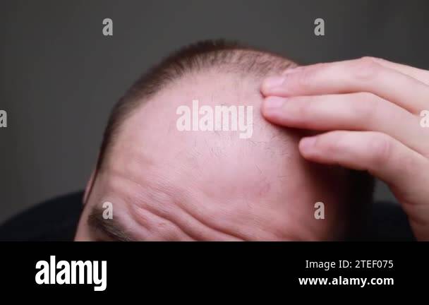 Man looks at the camera at his bald spots, the problem of hair loss ...