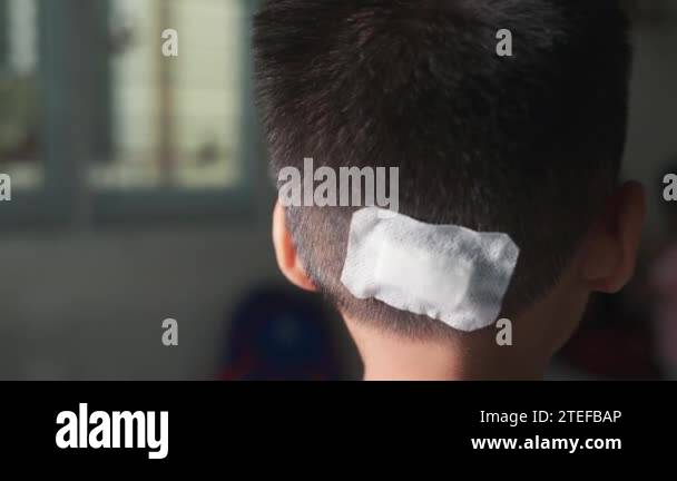 The lacerated suture wound of kid back head which suture with trauma ...