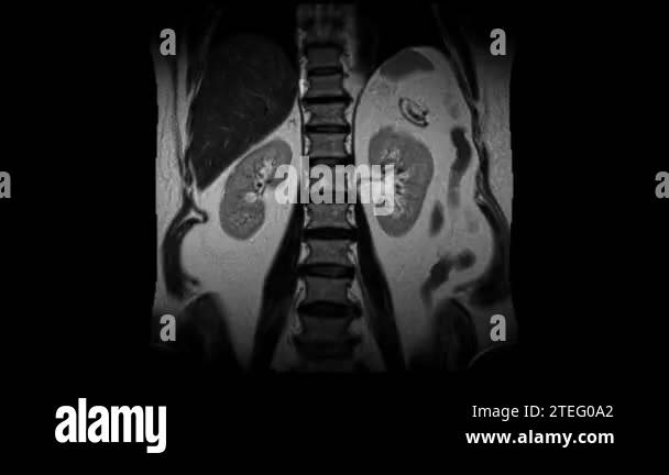 X-ray of the human abdomen. MRI of the kidneys and liver, as well as ...