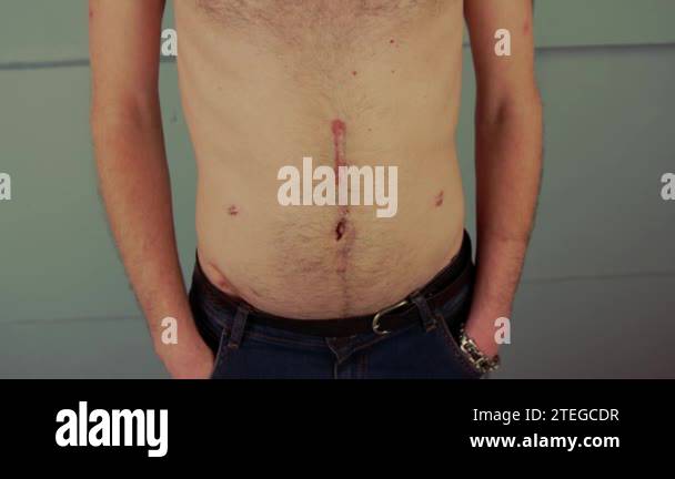 Anonymous shirtless man with scars on body. Crop unrecognizable ...