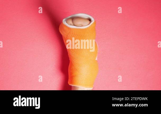 Foot with broken toe bone in orange fiberglass cast pink background ...