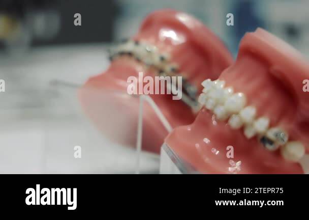 Model of the tooth gap on the placement of orthodontic brackets ...