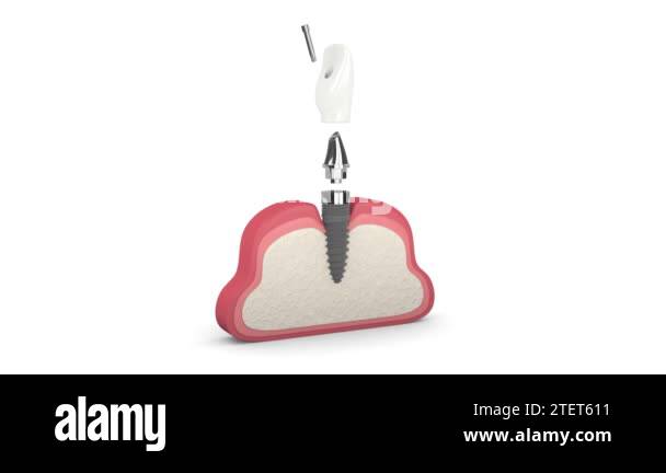 human gum with incisor dental implant installation over white ...