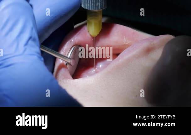 Close-up, the dentist gives an injection of anesthesia to a female ...