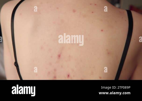 Shingles rash on back Stock Videos & Footage - HD and 4K Video Clips ...