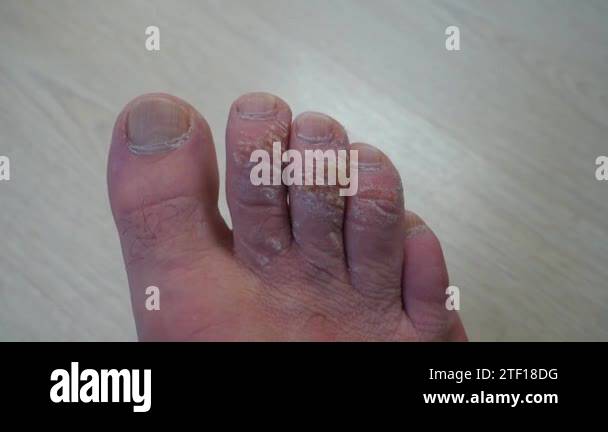 close-up foot skin diseases, callus formation on the fingers, calluses ...