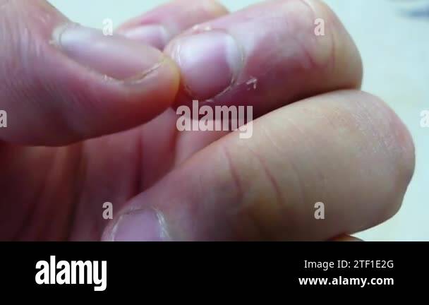 skin peeling on finger nails, vitamin C deficiency and nail skin ...
