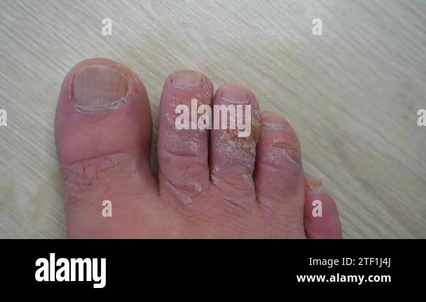 close-up foot skin diseases, callus formation on the fingers, calluses ...