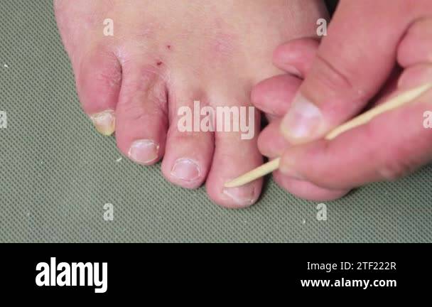 Finger nail cross section Stock Videos & Footage - HD and 4K Video ...