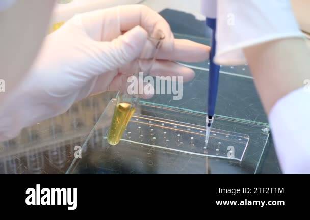 Quantitative determination of immunoglobulins in blood serum by radial ...