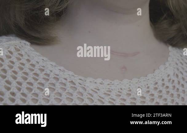 Scar on the neck. surgical wounds, removal of tumor and thyroid cancer ...