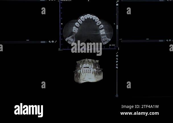 3d model of an x-ray image of a human jaw. Computer program for dental ...