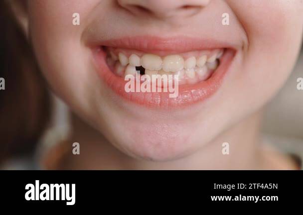 Close-up mouth child has lost one milk teeth. Replacement of permanent ...