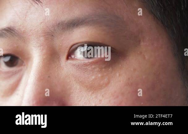 Asian men have dry eyes. concept of eye disease Eye health check ...