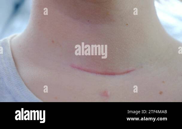 Girl's neck in motion close-up. Mark on the neck after surgery ...