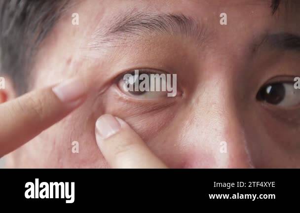 Asian men have dry eyes. concept of eye disease Eye health check ...