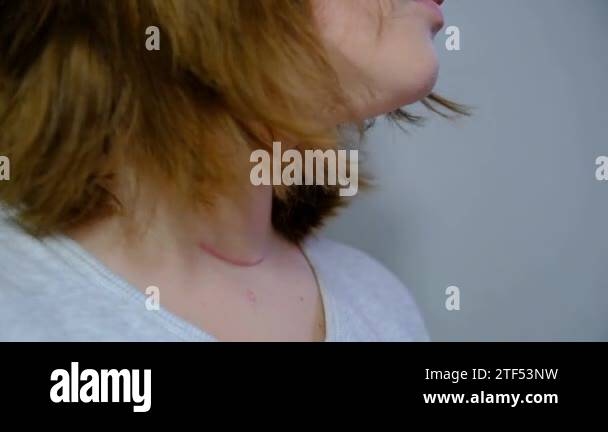 Girl's neck in motion close-up. Mark on the neck after surgery ...