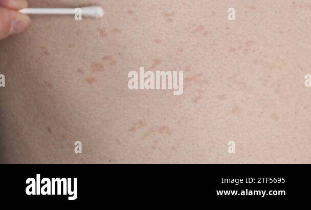 Mans hand smears areas of skin infected with pityriasis versicolor with ...