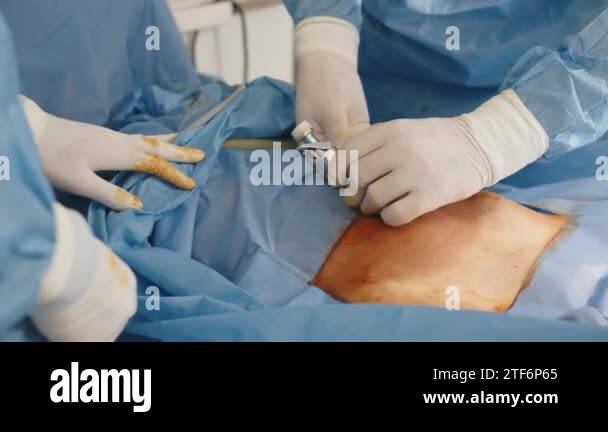 Team surgeon at work on laparoscopy operation in hospital. Close up. In ...