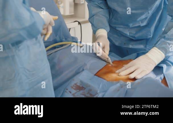 Operating theater. Team of doctors doing a surgery to a patient lying ...