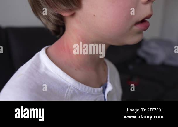 Allergic skin reaction on the childs neck and face - red rash. Symptoms ...