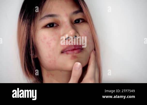 Rash face red woman Stock Videos & Footage - HD and 4K Video Clips - Alamy