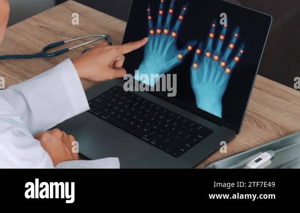 Woman doctor showing a x-ray of hands with pain in the joints on a ...