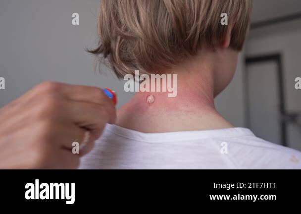 Red pustules and vesicles on the skin of the neck as symptoms of ...