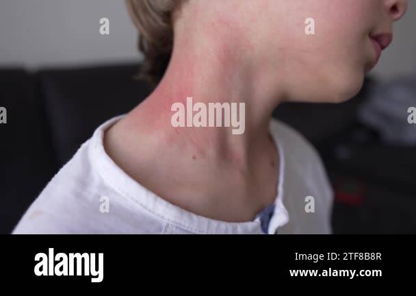 Allergic skin reaction on the childs neck and face - red rash. Symptoms of photodermatitis ...