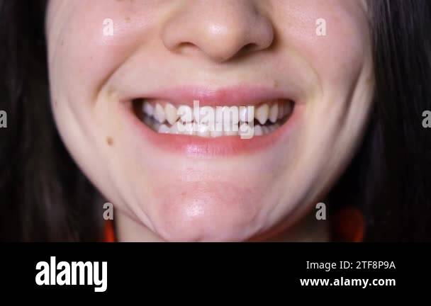 A woman with malocclusion and dysfunction of the temporomandibular ...