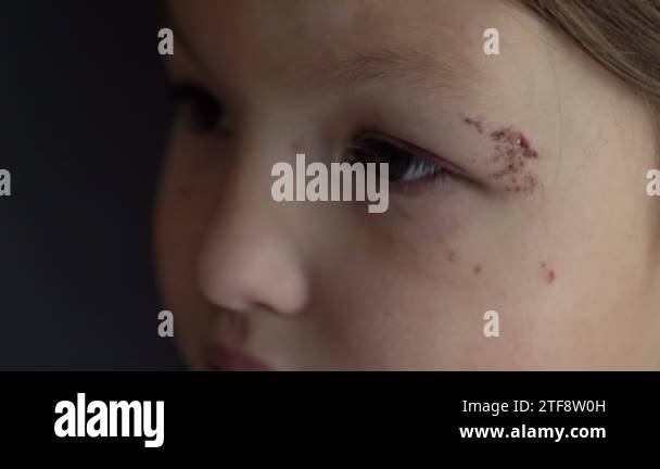 Eyebrow wound Stock Videos & Footage - HD and 4K Video Clips - Alamy