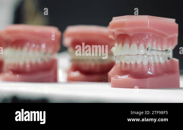 Model of the tooth gap on the placement of orthodontic brackets ...