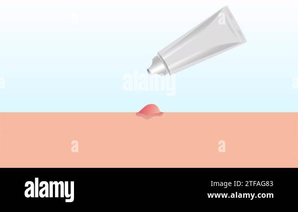 Applying gel, cream, ointment from tube on pimple. Skincare, breakout ...