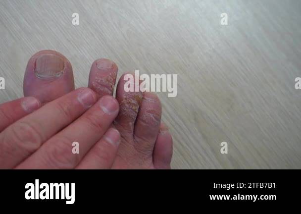 person with calluses on toes scratches his fingers, checking them ...