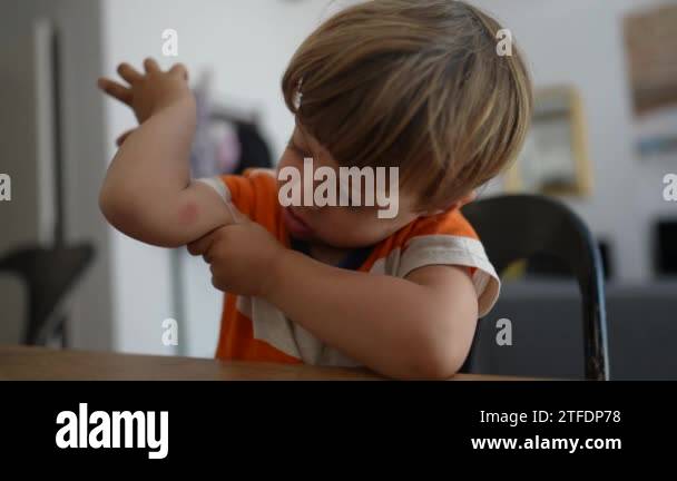 Kid showing mosquito bite child shows insect bite in arm Stock Video ...
