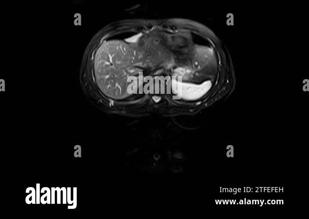 CT scan of the abdomen. Computed tomography of the gastrointestinal ...