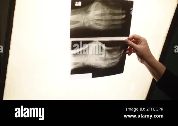 The nurse's hand is holding a x-ray photo of the arm. Arm fracture ...
