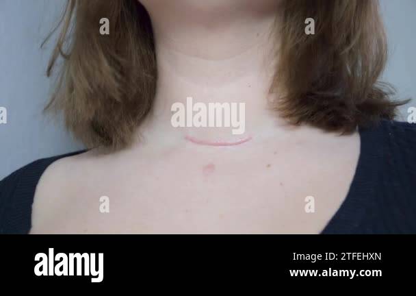 Girl's neck in motion close-up. Mark on the neck after surgery ...